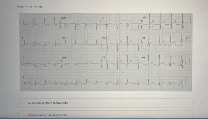 Solved Identify the rhythm. V4 VL ppp p EVT mwiſhffihhhh | Chegg.com