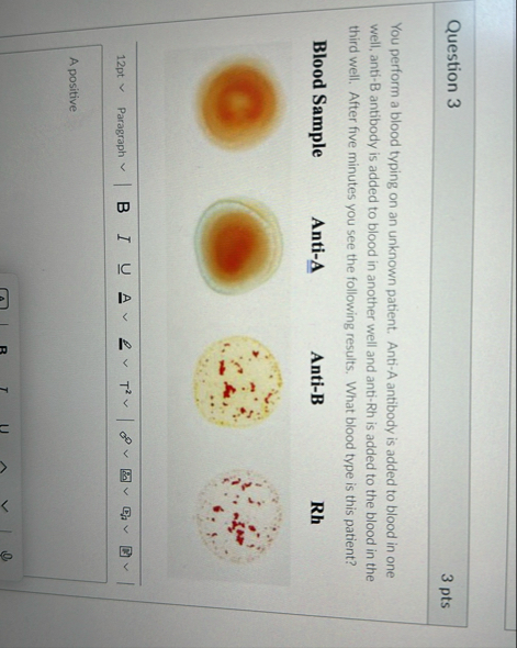 Solved Question 33 ﻿ptsYou perform a blood typing on an | Chegg.com