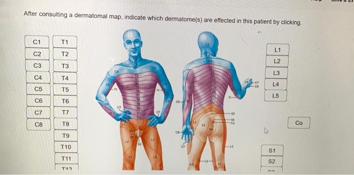 After consulting a dermatomal map, indicate which | Chegg.com