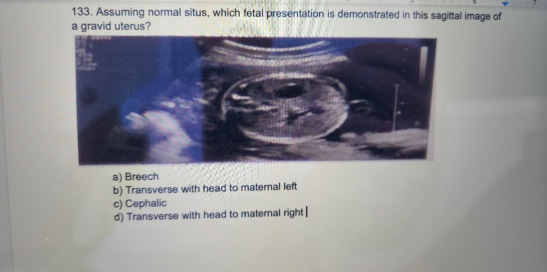 Solved 133. Assuming normal situs, which fetal presentation | Chegg.com