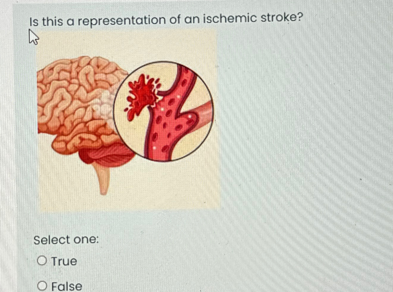 Solved Is this a representation of an ischemic stroke?Select | Chegg.com