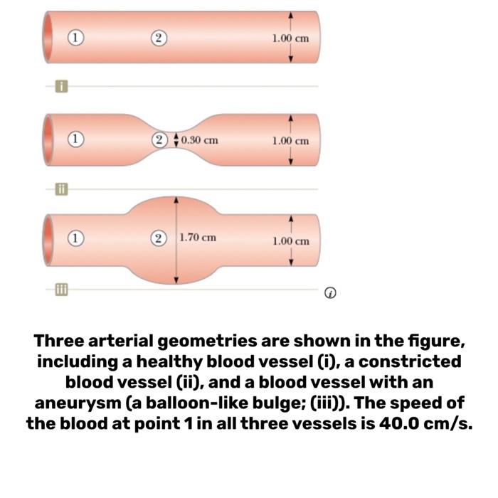 Solved Three arterial geometries are shown in the figure, | Chegg.com