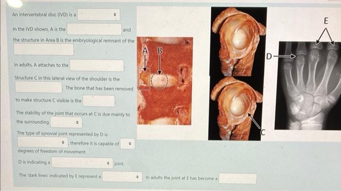 Solved An intervertebral disc (IVD) is a In the IVD shown A | Chegg.com