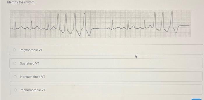 Solved Identify the rhythm. السياسا Polymorphic VT Sustained | Chegg.com