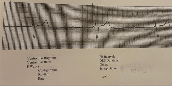 Solved Ventricular Rhythm: PR Interval: Ventricular Rate: | Chegg.com