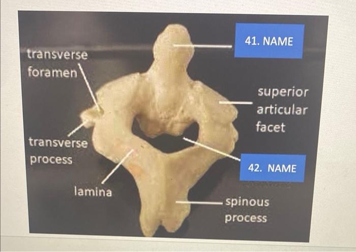 Solved 41. NAME transverse foramen superior articular facet | Chegg.com