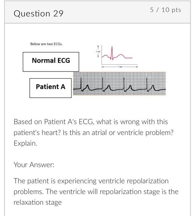 Solved 5 / 10 pts Question 29 Below are two ECGS. Normal ECG | Chegg.com