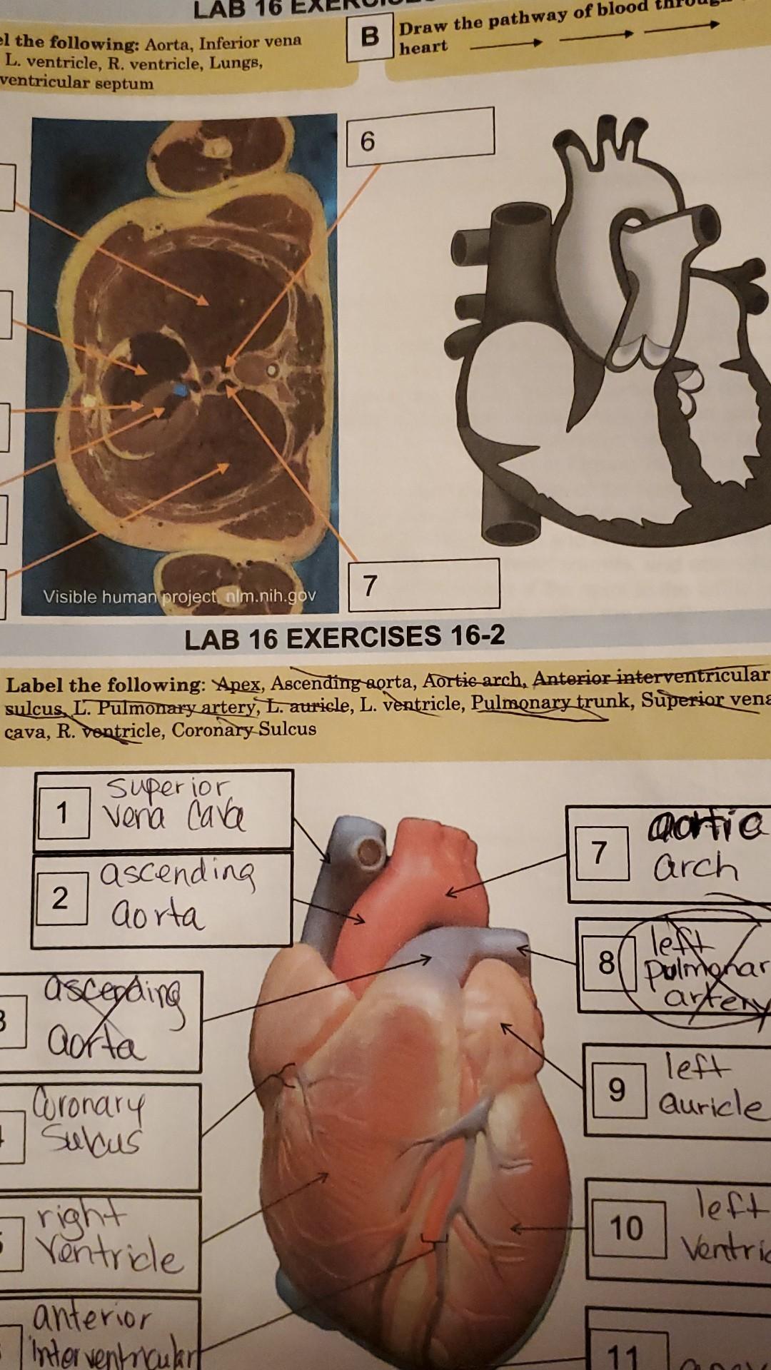 Interventricular Sulcus And Septum