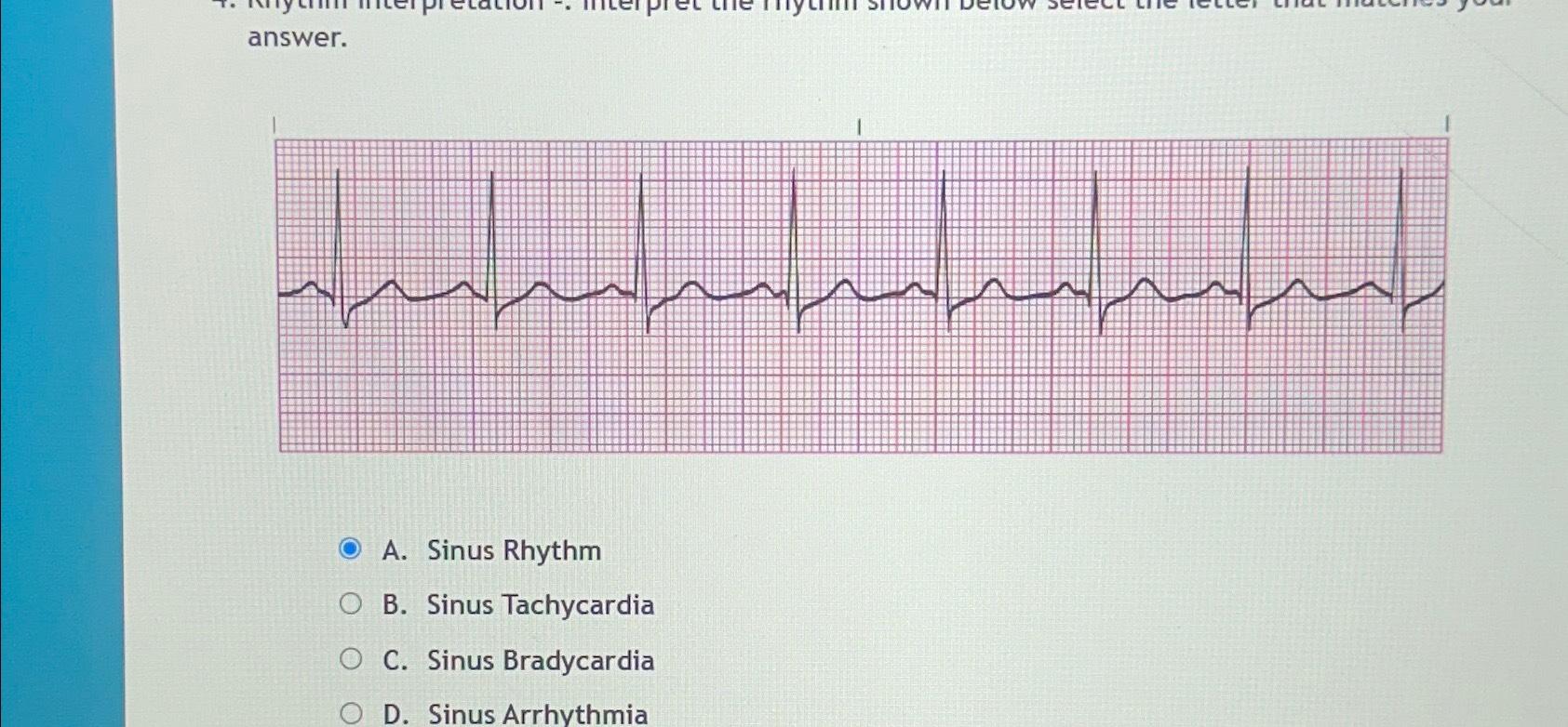 answer.1A. ﻿Sinus RhythmB. ﻿Sinus TachycardiaC. | Chegg.com