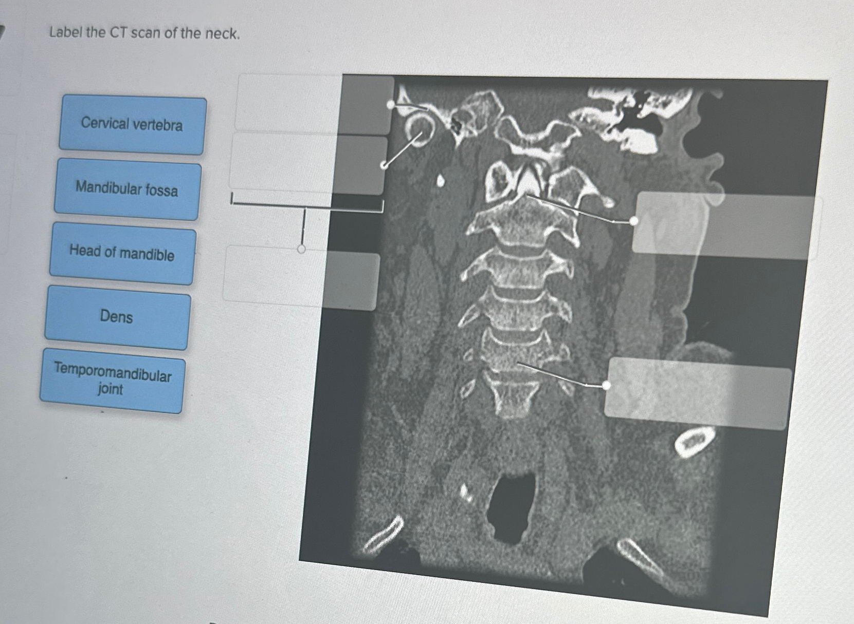 Solved Label the CT scan of the neck.Temporomandibular joint | Chegg.com
