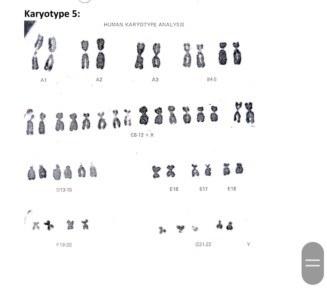 Solved Karyotype 1: HUMAN KARYOTYPE ANALYSIS ፅ 88 00 A3 B4-5 | Chegg.com