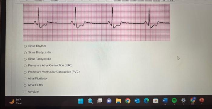 Solved Sinus Rhythm Sinus Bradycardia Sinus Tachycardia | Chegg.com