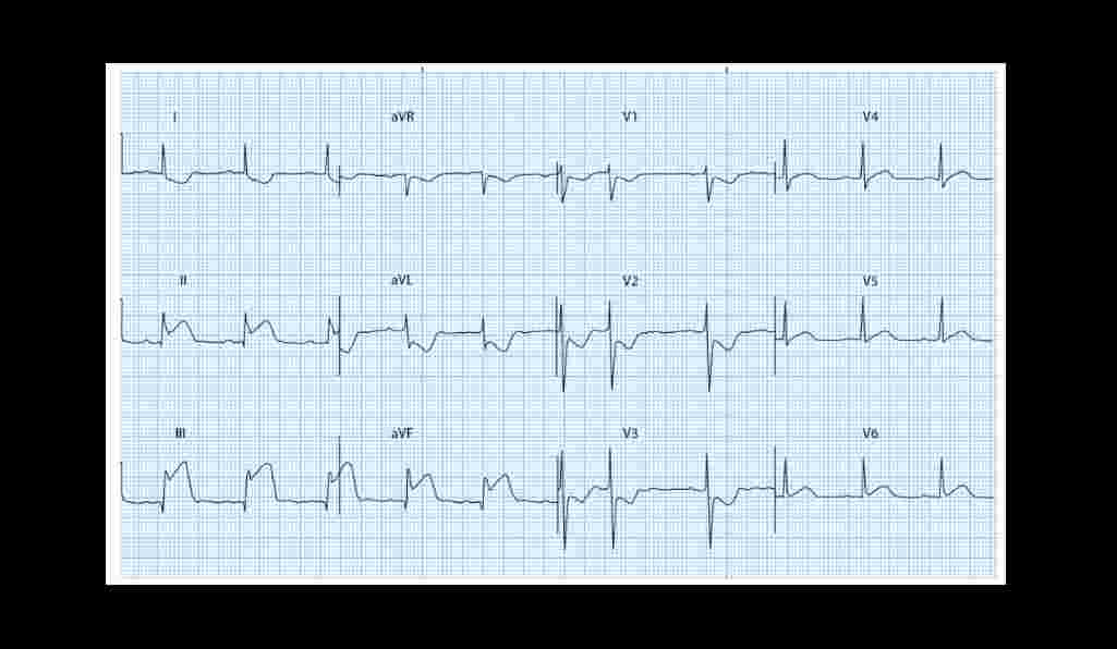 Solved what is the predominant finding of ischemia or | Chegg.com