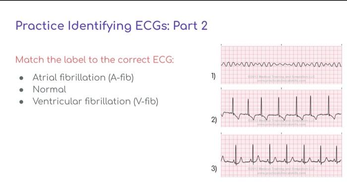Solved Practice Identifying ECGs: Part 2 Match the label to | Chegg.com