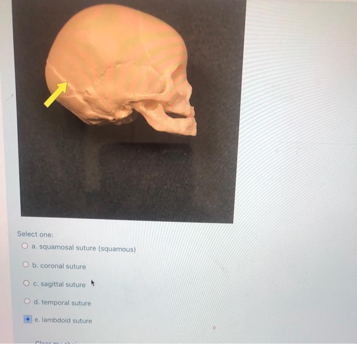 Solved Select One O A Squamosal Suture Squamous B