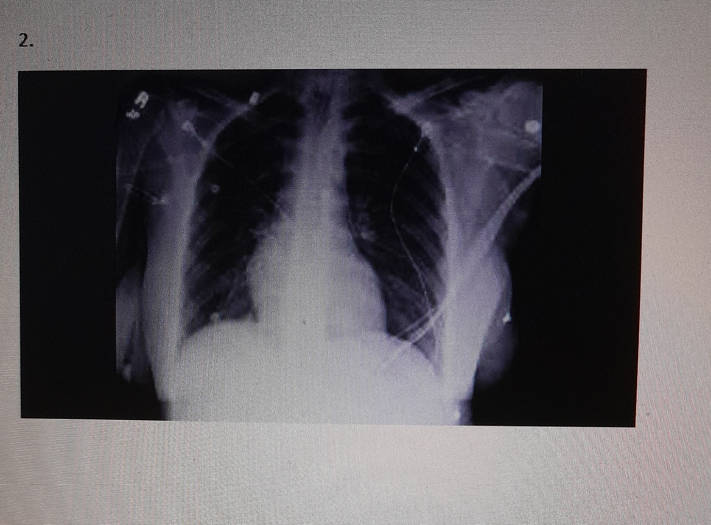 identify each chest x-ray as normal or abnormal if | Chegg.com