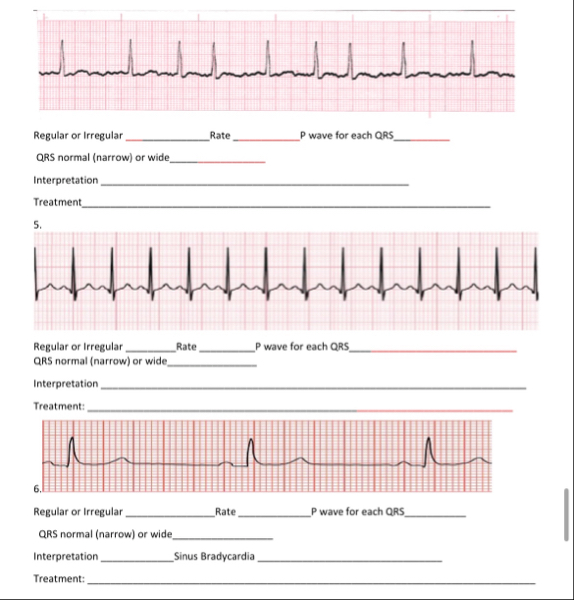 Regular or Irregular _Rate?3 ﻿wave for each QRS.QRS | Chegg.com
