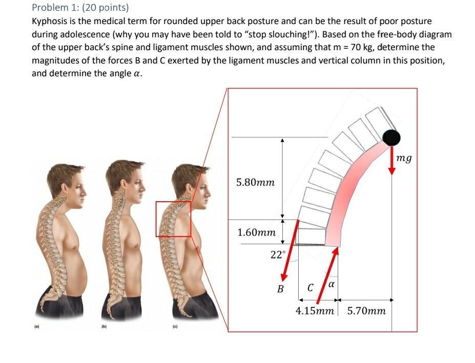 Solved Problem 1: (20 points) Kyphosis is the medical term | Chegg.com