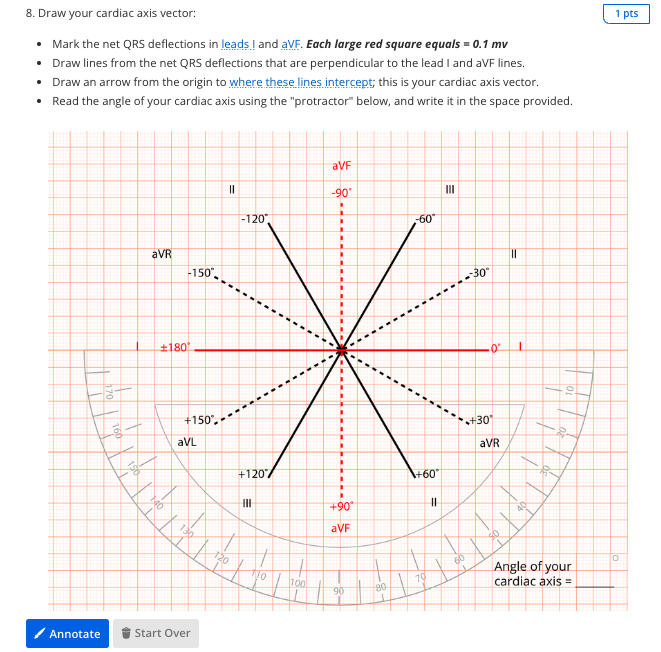 Solved Draw your cardiac axis vector: | Chegg.com