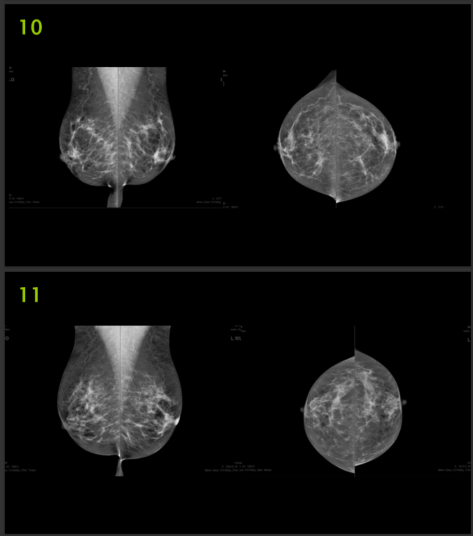 Solved the image below are mammography images please | Chegg.com