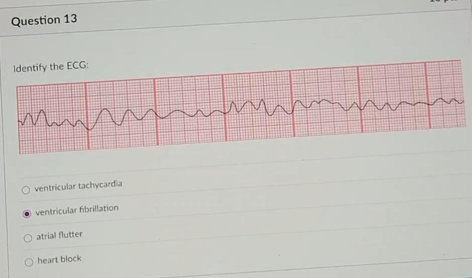 Solved Identify the ECG: heart block ventricular tachycardia | Chegg.com