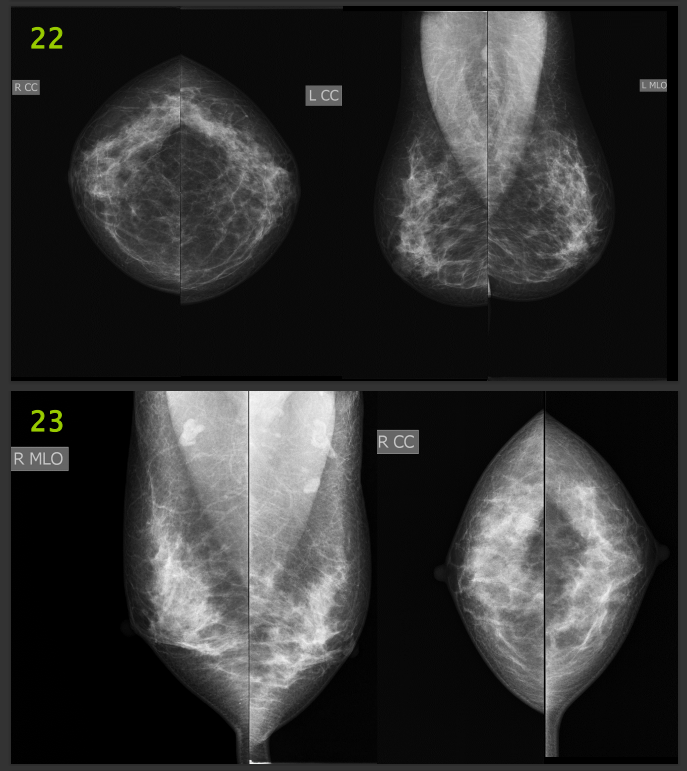 Solved the image below are mammography images please | Chegg.com