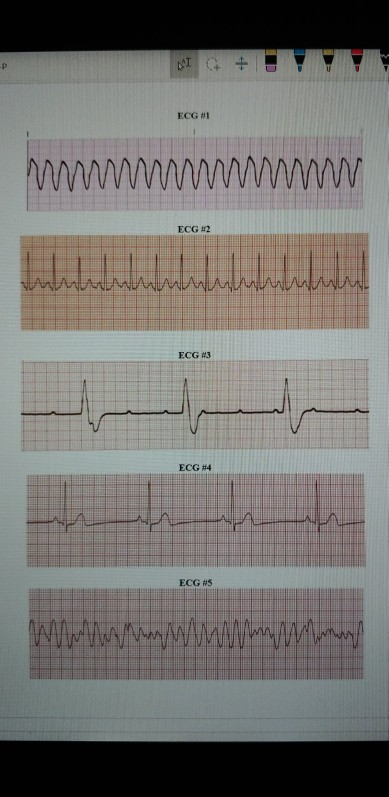 Solved 7. Ventricular Arhythmins The ECG of a patient with | Chegg.com
