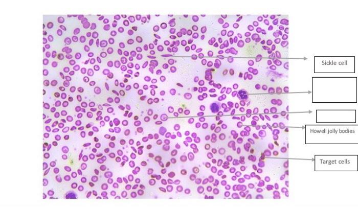 Solved > Sickle cell Howell jolly bodies Target cells | Chegg.com