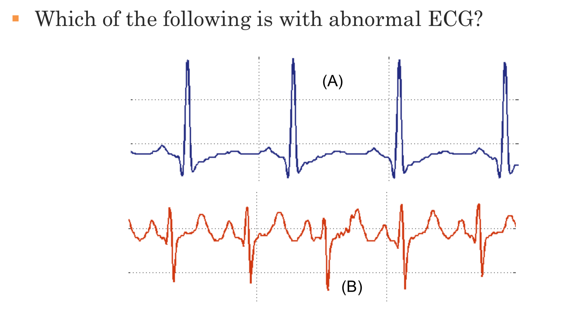 Solved Which of the following is with abnormal ECG? | Chegg.com