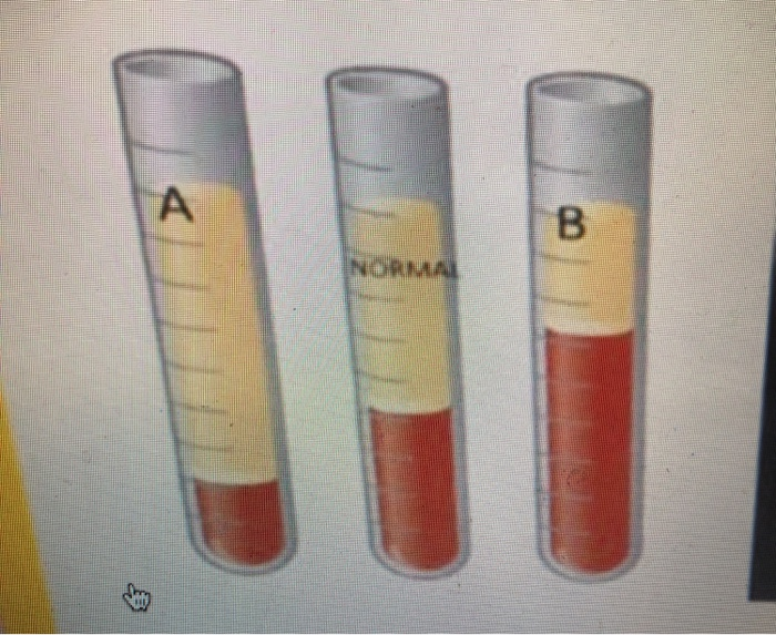 5. Review the blood vials provided. A normal one was | Chegg.com