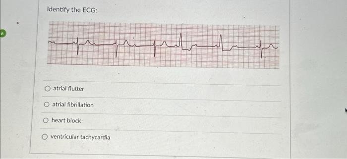 Which heart problem is associated with this ECG | Chegg.com