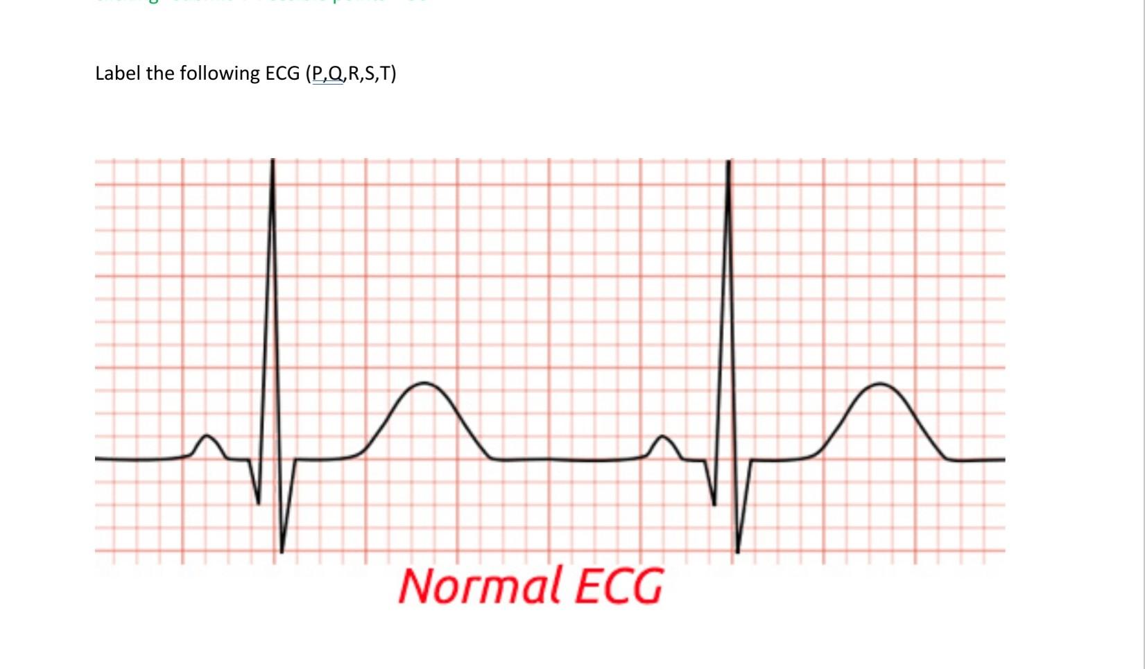 Solved Label the following ECG (P,Q,R,S,T) Normal ECG | Chegg.com
