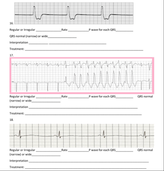 Solved 1Regular or Irregular .RateP wave for each QRSq,QRS | Chegg.com
