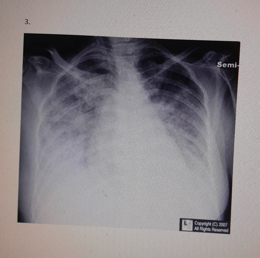 Solved identify each chest x-ray as normal or abnormal if | Chegg.com