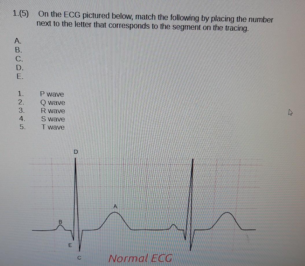 Solved 1.(5) On the ECG pictured below, match the following | Chegg.com