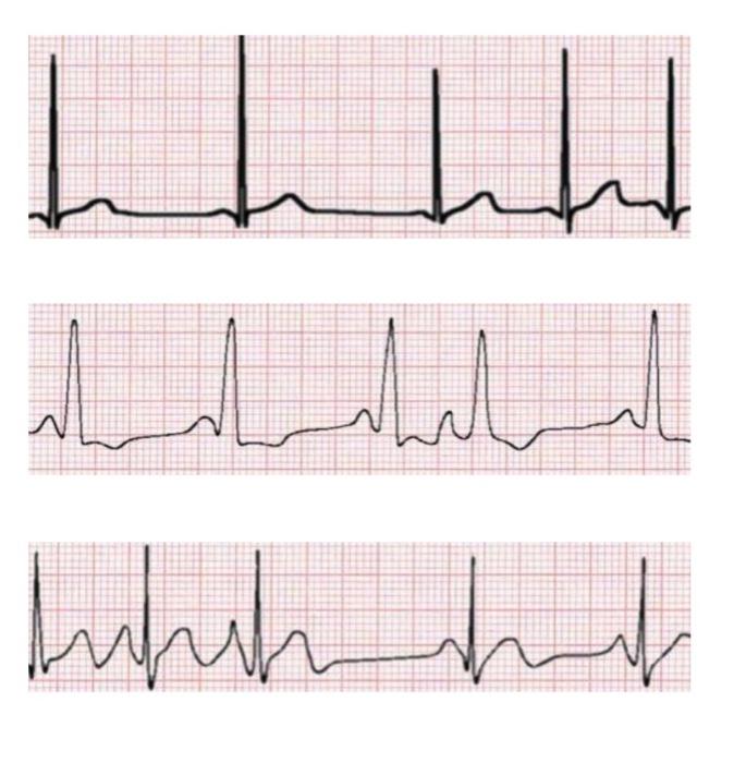 Solved QI. CALCULATE HEART RATE USING 3 RR FOR EACH ECG | Chegg.com