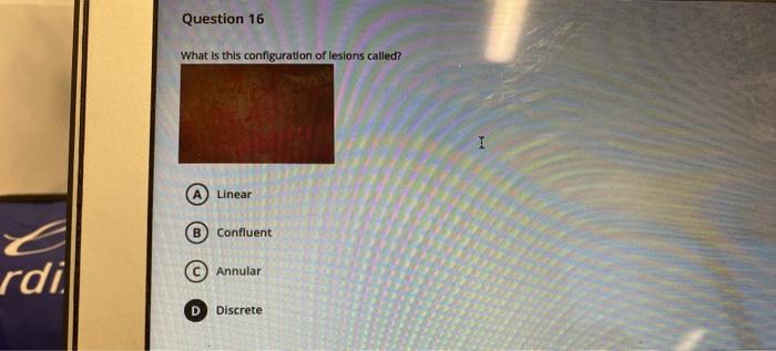 Solved What is this lesion called? Vesicle Wheal | Chegg.com