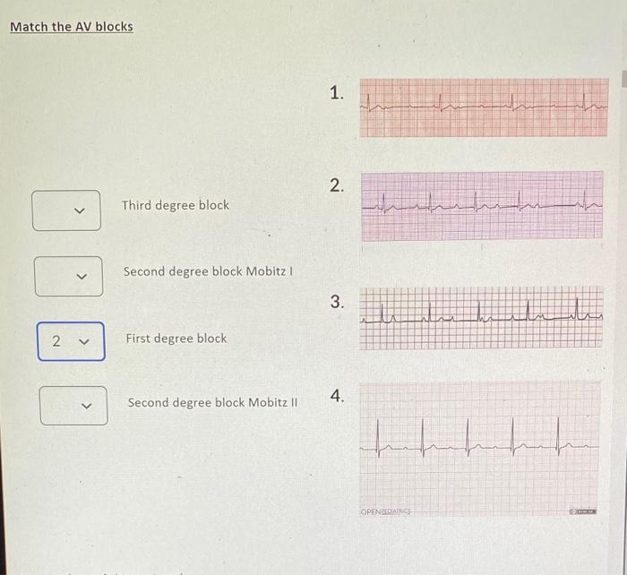 Solved Match the AV blocks 1. Third degree block 2. Second | Chegg.com