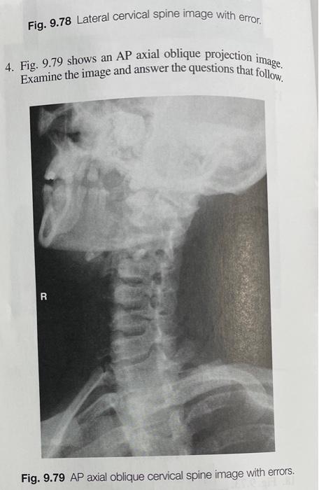 Oblique Cervical Spine Xray