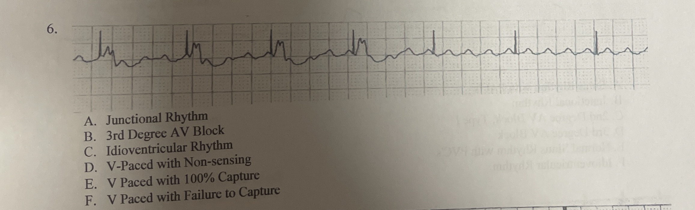 Solved A. ﻿Junctional RhythmB. 3rd Degree AV BlockC. | Chegg.com