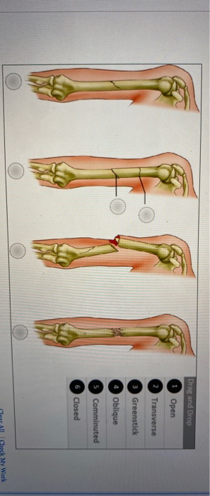 Solved Drag and Drop 1 Open Transverse 3 Greenstick 4 | Chegg.com