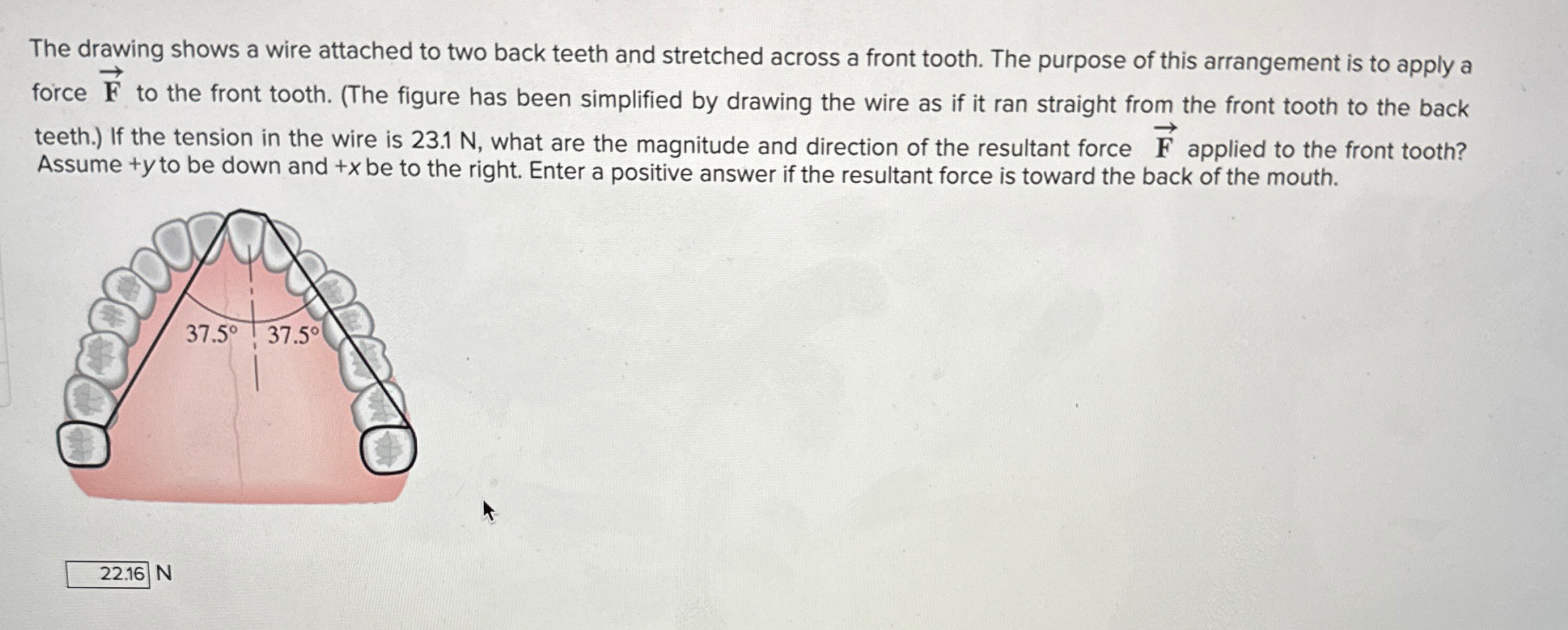 Solved The drawing shows a wire attached to two back teeth | Chegg.com