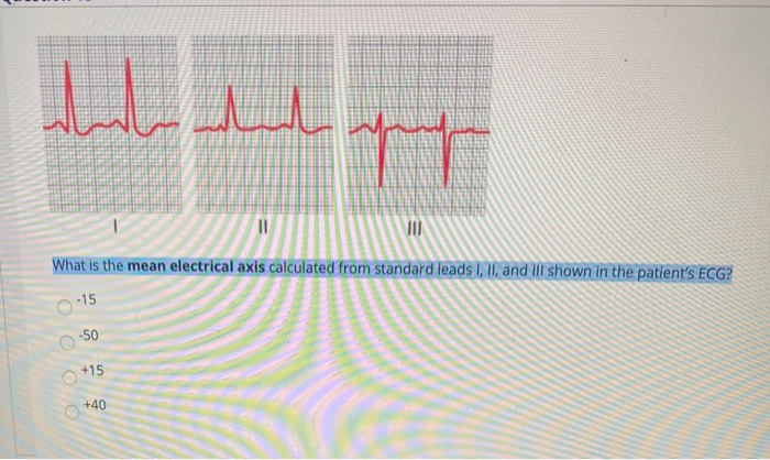 Solved Question 13 An ST segment shift corresponds to all of | Chegg.com