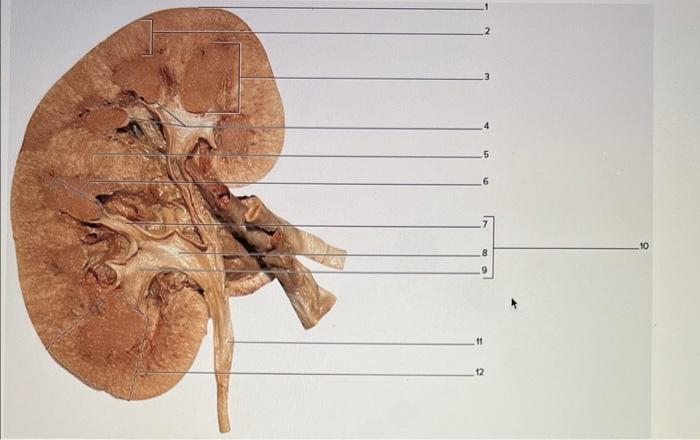 Solved - fibrous capsule - major calyx - minor calyx - | Chegg.com