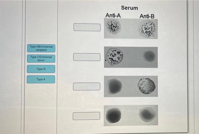 Solved Serum Anti-A Anti-B Type AB/Universal recipient Type | Chegg.com
