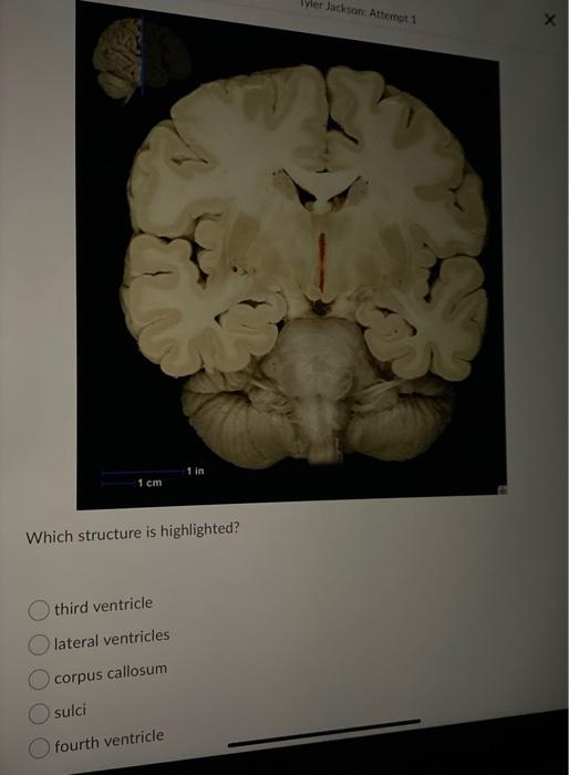 Solved Which structure is highlighted? ventral rootlets | Chegg.com