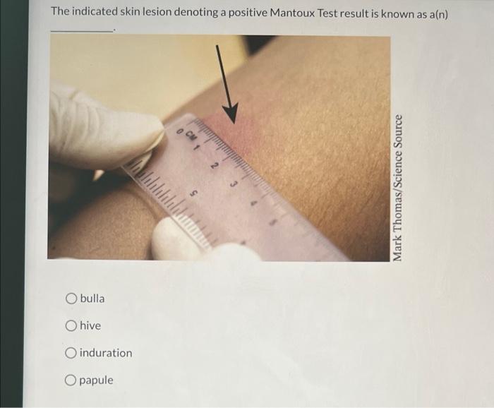 Positive Ppd Induration Size