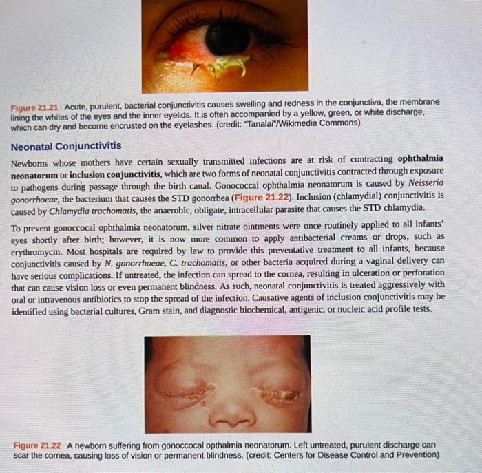 Solved Bacterial Conjunctivitis Like The Skin The Surface