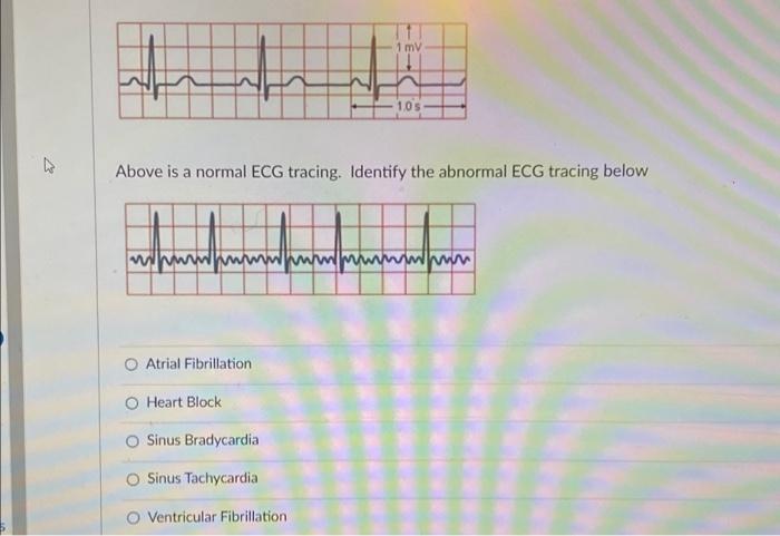 Solved Above is a normal ECG tracing. Identify the abnormal | Chegg.com