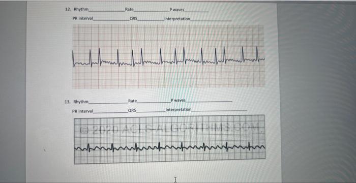 12. Phythm Pate P waves PR interval a9s | Chegg.com
